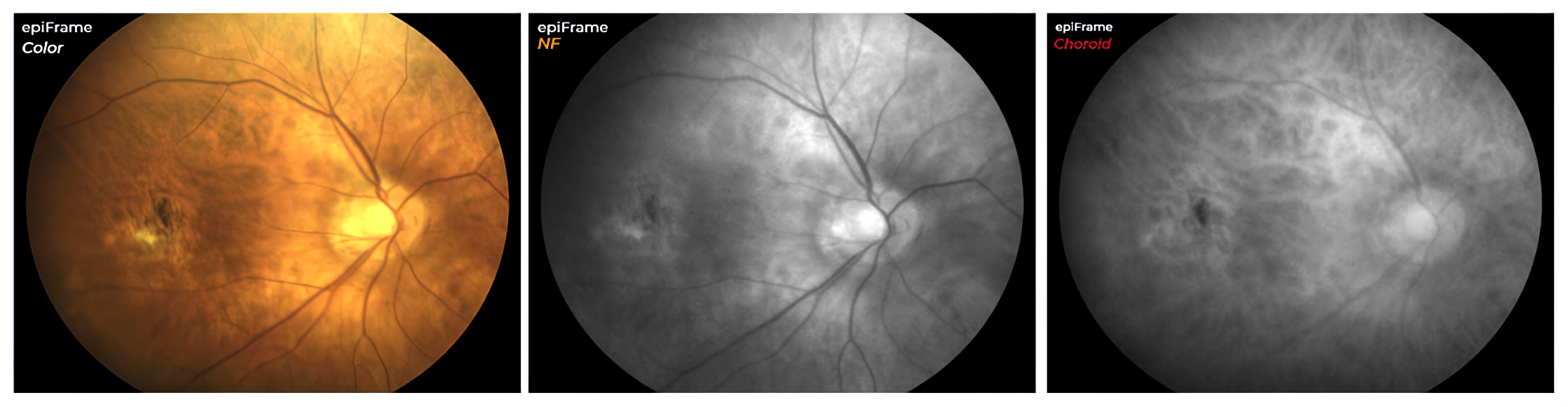 Picture Perfect: Retinal Imaging Brings Eye Health into Focus - Epipole